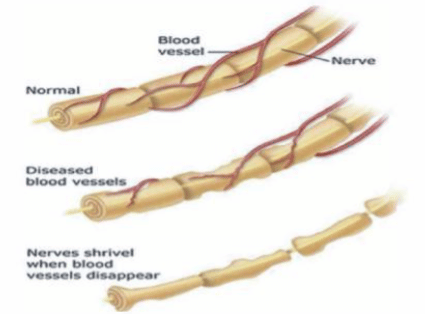 Nerve Damage - Innovative Nerve & Joint Centers